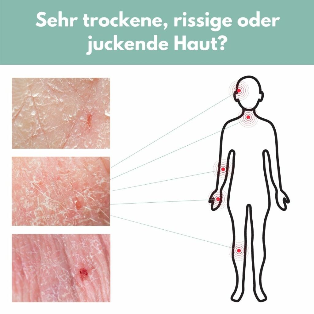 ISO-Intensivcreme | benevi neutral | juckende Altershaut